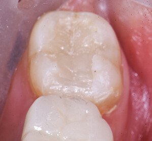 Ecosite One: The innovative layering composite by DMG.