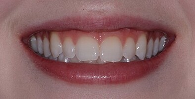 Icon Smooth Surface: Aesthetic treatment of white spots