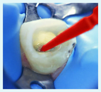 LuxaBond Total Etch, the dual-curing adhesive system