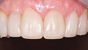 Ecosite Elements by DMG: Your universal composite system