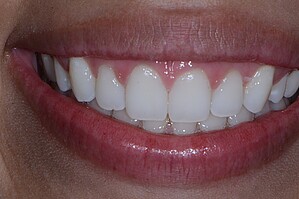 Icon Smooth Surface: Aesthetic treatment of white spots