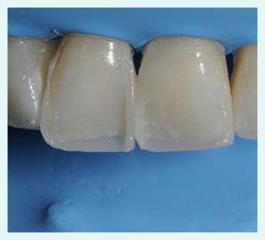 Ecosite Elements by DMG: Your universal composite system