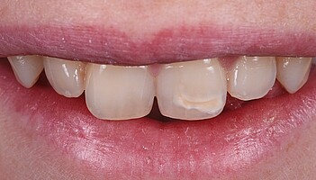 Icon Smooth Surface: Aesthetic treatment of white spots