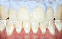 Icon Smooth Surface: Aesthetic treatment of white spots