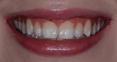 Icon Smooth Surface: Aesthetic treatment of white spots