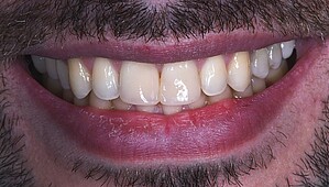 Ecosite Elements by DMG: Your universal composite system