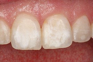 Icon Smooth Surface: Aesthetic treatment of white spots