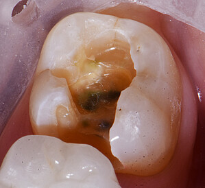 Ecosite One: The innovative layering composite by DMG.