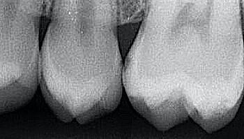 Icon Proximal: Caries infiltration as a gentle alternative to drilling