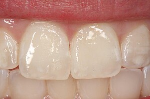 Icon Smooth Surface: Aesthetic treatment of white spots