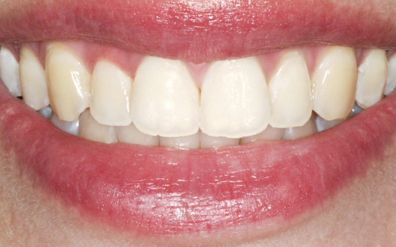 Icon Smooth Surface: Aesthetic treatment of white spots