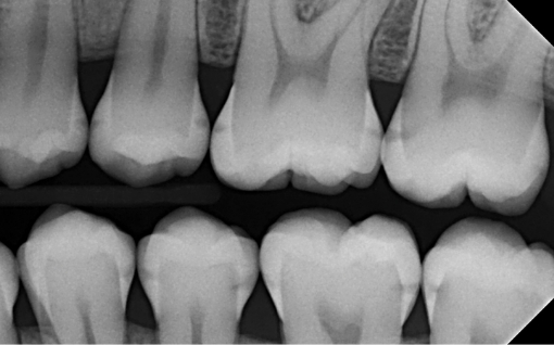 Icon Proximal: Caries infiltration as a gentle alternative to drilling